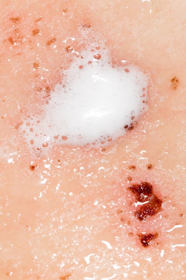 Wound on Human Skin in Hydrogen Peroxide Stock Image - Image of microbe ...
