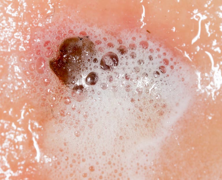 Wound on Human Skin in Hydrogen Peroxide Stock Photo - Image of ...