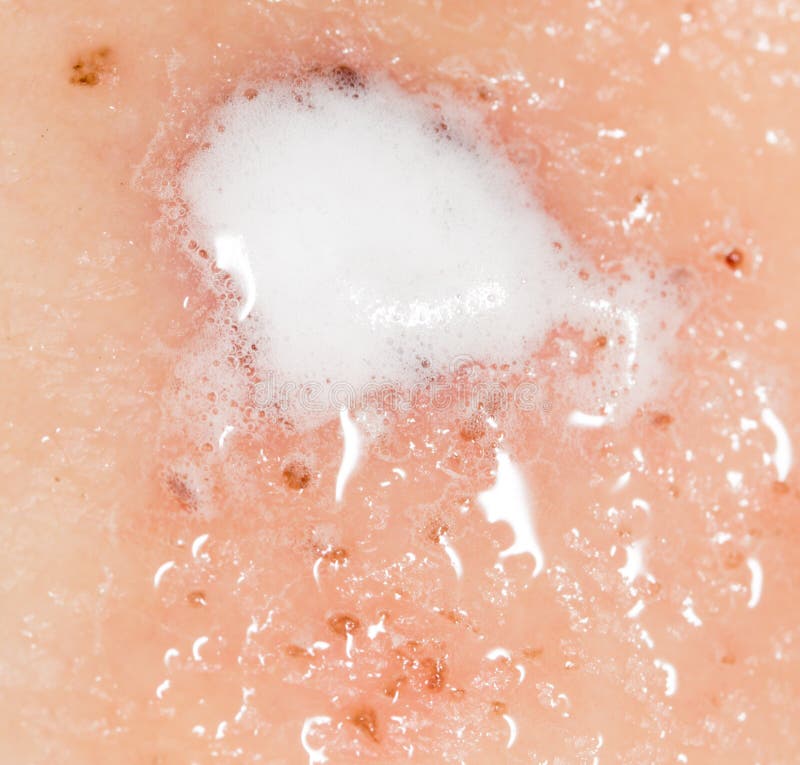 Wound on Human Skin in Hydrogen Peroxide Stock Image - Image of pain ...