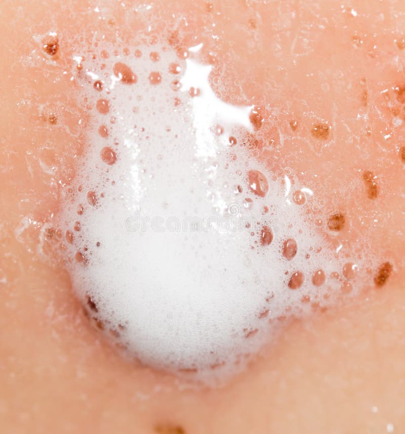 Wound on Human Skin in Hydrogen Peroxide Stock Image - Image of ...