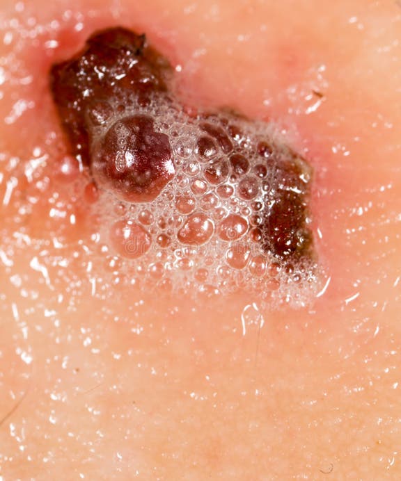 Wound on Human Skin in Hydrogen Peroxide Stock Photo - Image of hand ...