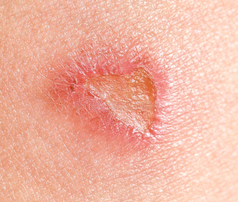 Wound on human skin. stock photo. Image of injured, texture - 140861250