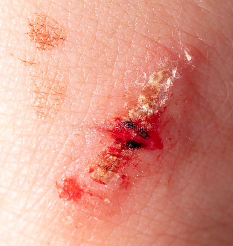 Wound on human skin. Macro stock photo. Image of child - 270122516