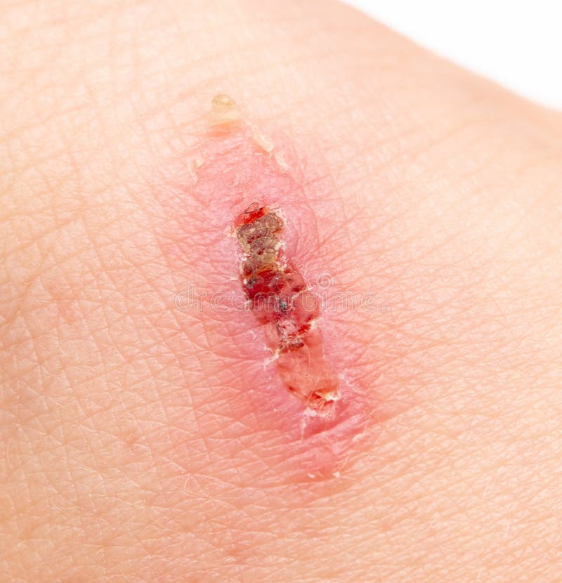 Wound on human skin. Macro stock image. Image of medicine - 270121639