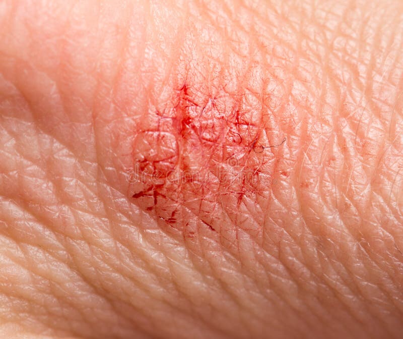 Wound on the Human Skin. Macro Stock Photo - Image of scab, pain: 100862142