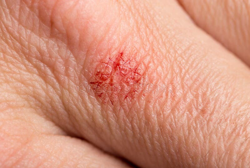 Wound on the Human Skin. Macro Stock Image - Image of physical, human ...