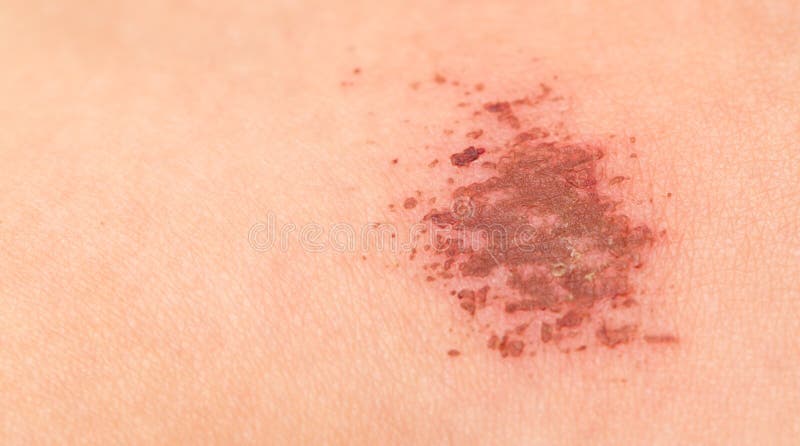Wound in human skin stock photo. Image of cuts, inflammation - 107516848