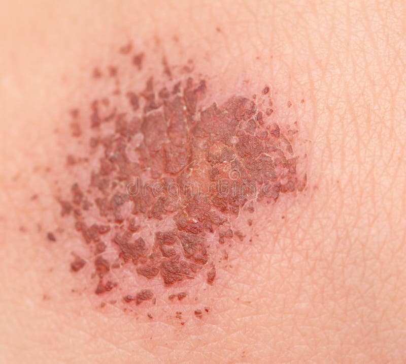 Wound in human skin stock image. Image of blood, injury - 88855237