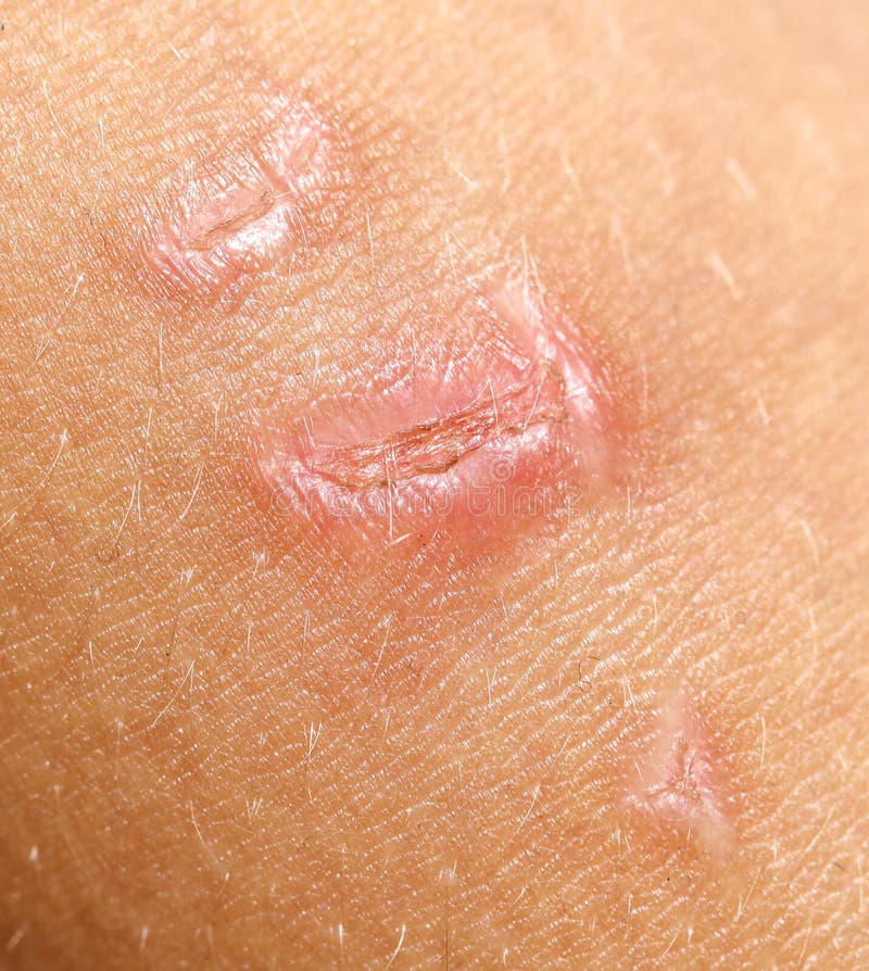 Wound on human skin. stock photo. Image of wound, bleed - 140883740