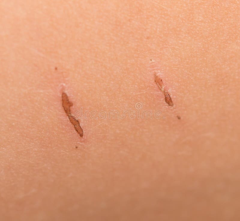 Wound in human skin stock image. Image of medicine, healthcare - 106833651
