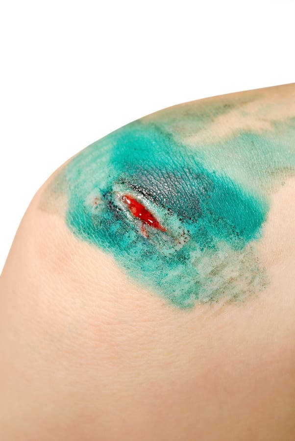 Wound on a Knee of the Child Stock Image - Image of green, band: 19840259
