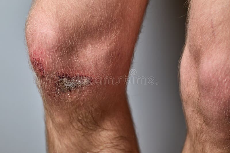 The Wound on the Knee Was Treated with Hydrogen Peroxide Stock Photo ...