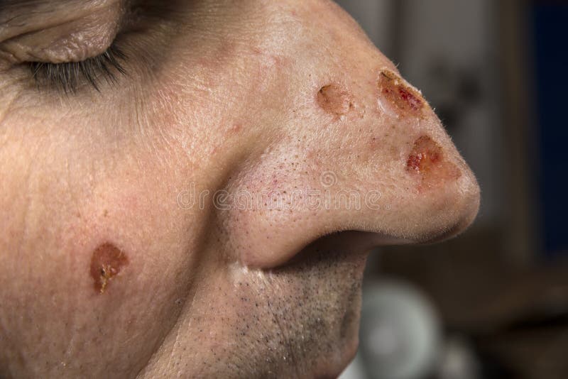 Wound from Laser on a Face from Dermatologist Stock Image - Image of ...
