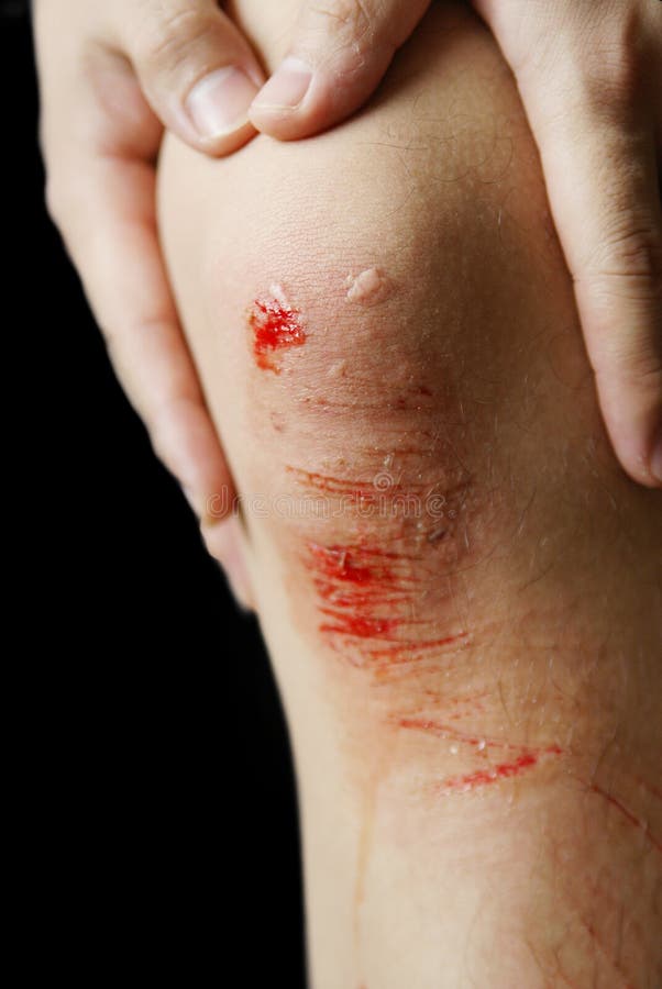 Wound Leg stock image. Image of wound, cure, black, appeasement - 5370029