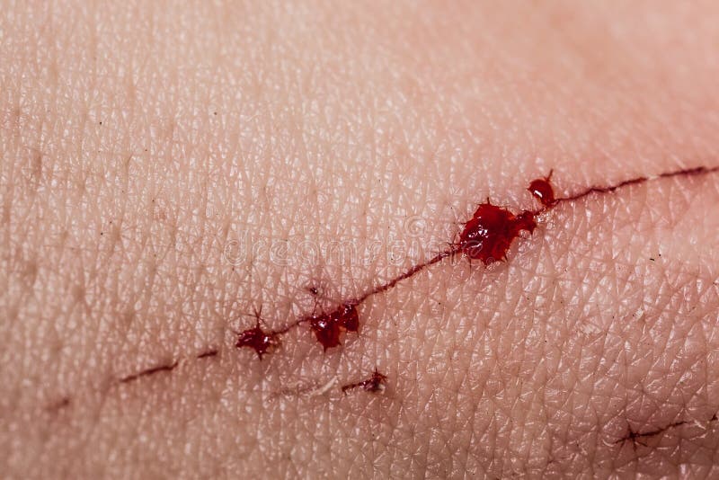 Wound Royalty Free Stock Images - Image: 30485389