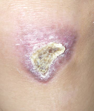 Wound with scab stock photo. Image of healing, scab, skin - 34818076