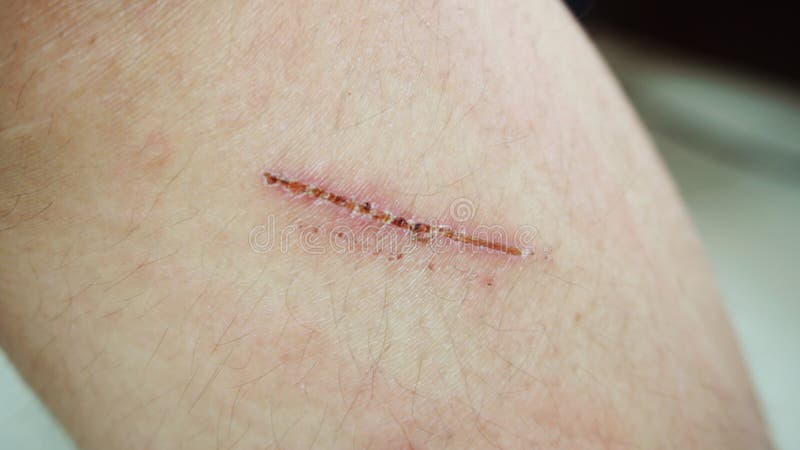Wound with Scabs on the Knee of Woman Stock Image - Image of macro ...