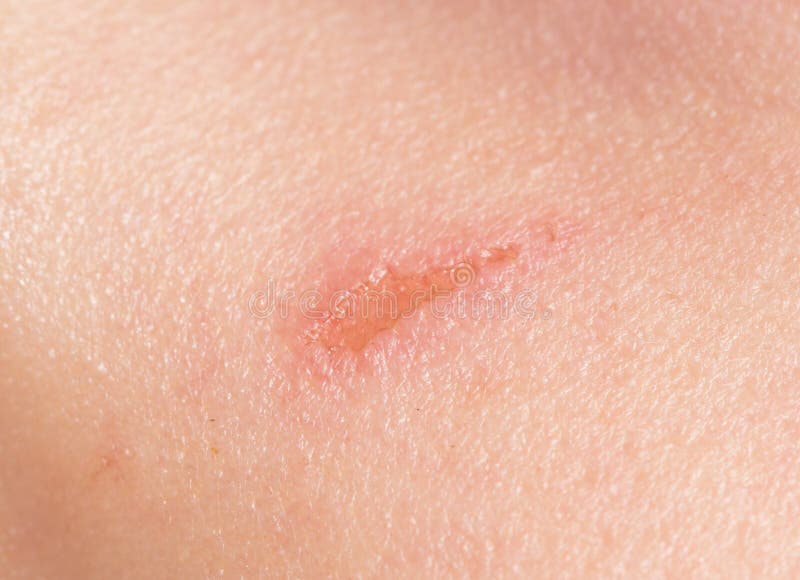 A wound on the skin. close stock image. Image of frame - 93590865
