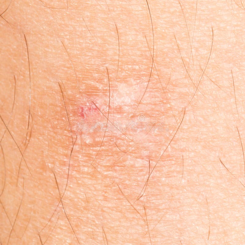 Wound on the Skin. Close-up Stock Image - Image of girl, hurt: 100408869