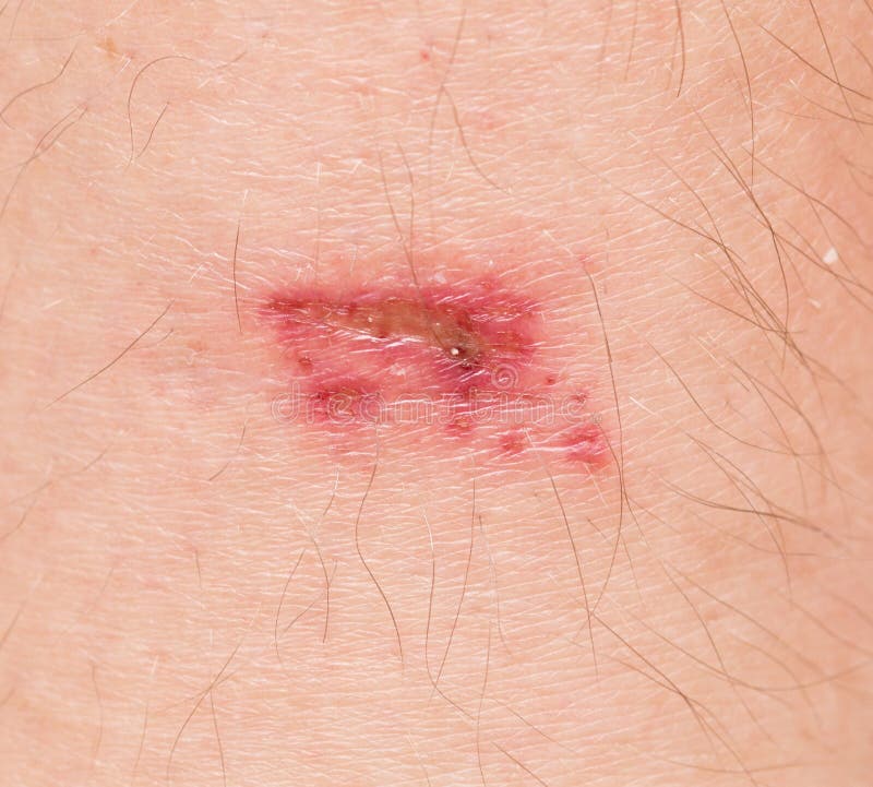 Wound on skin stock image. Image of healthcare, physical - 102212095