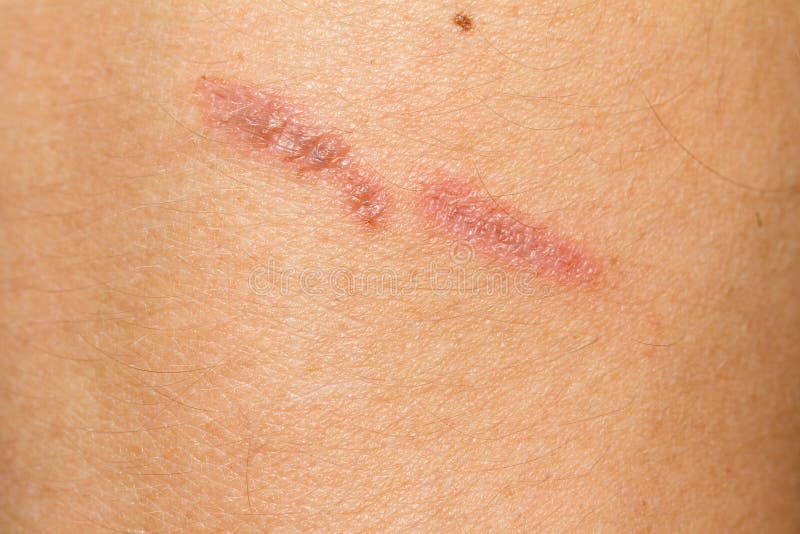 Wound on the skin stock photo. Image of problems, carcinoma - 64430622