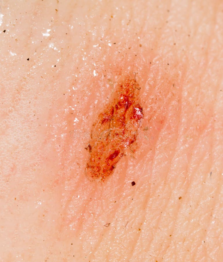 Wound on the Skin of a Person Stock Photo - Image of medicine, human ...
