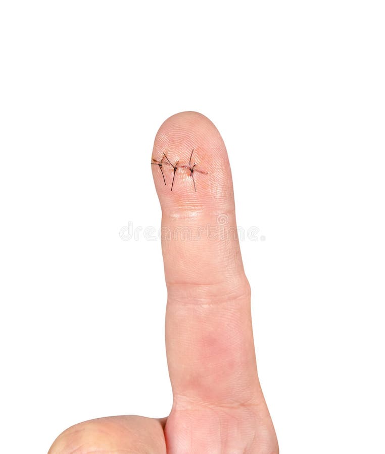 Wound with stitched finger stock photo. Image of wound - 65060768