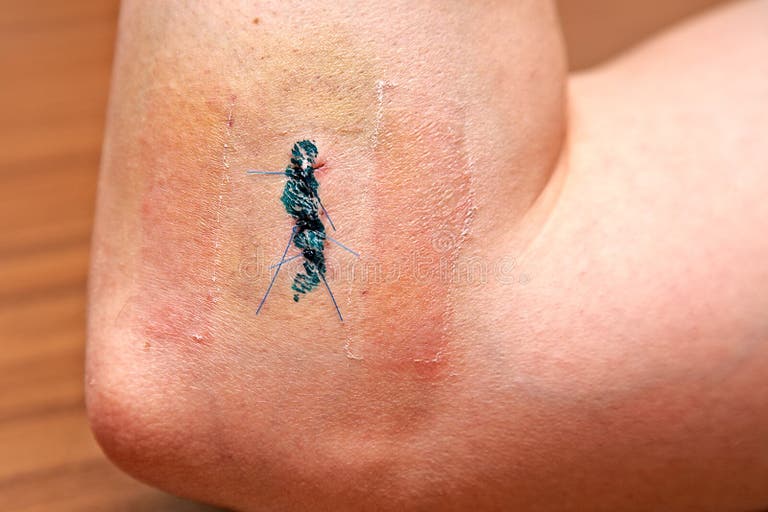 Wound with Stitches after Surgery Operation Stock Image - Image of ...