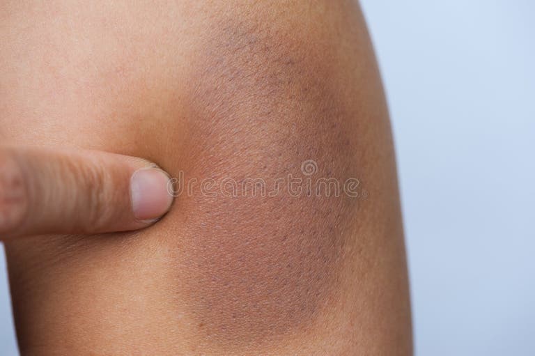 Wounded arm stock photo. Image of livid, injured, bruises - 116636930