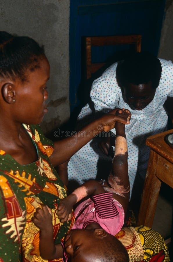 A Wounded Child at a Health Centre in Burundi. Editorial Image - Image ...