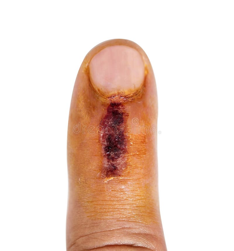 Wounded finger stock photo. Image of dermatological, finger - 60097018