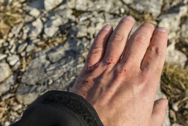 Wounded His Hand on the Stones Stock Image - Image of outdoors, tiny ...