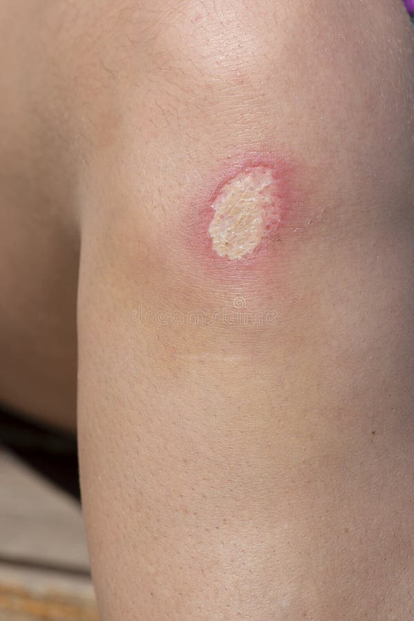 Wounded leg, close up stock image. Image of knee, hurt - 96526677