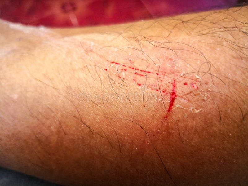 Scratch Lesion Caused by the Accident on Leg Skin. Stock Photo - Image ...