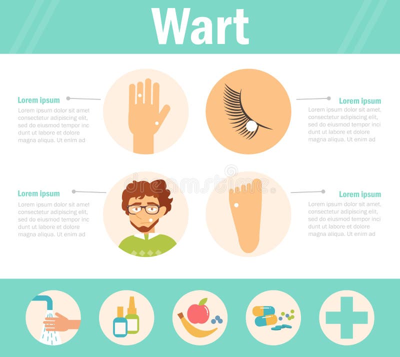 Hand Met Wratten En Papillomavirus Stock Illustratie - Illustration of ...