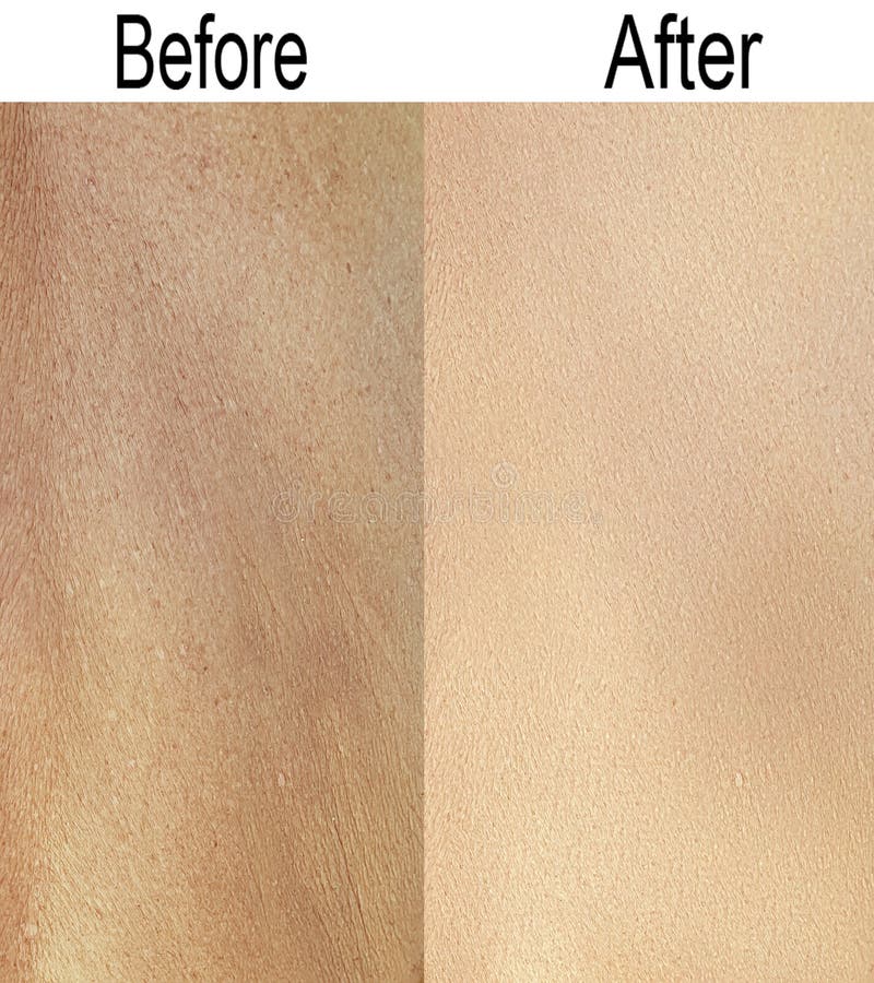 Wrinkle Skin before and after Treatment Effect Difference Stock Image ...