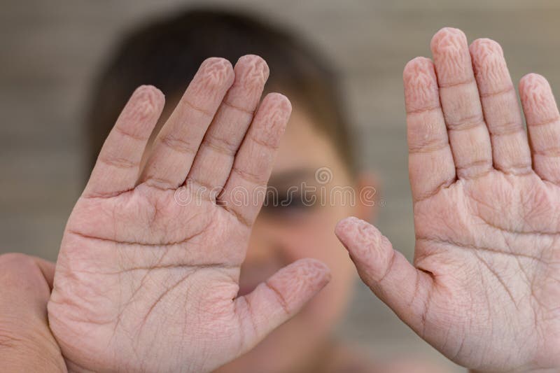 Wrinkled Hands of a Child Due To Long Soaking in Water Stock Image ...