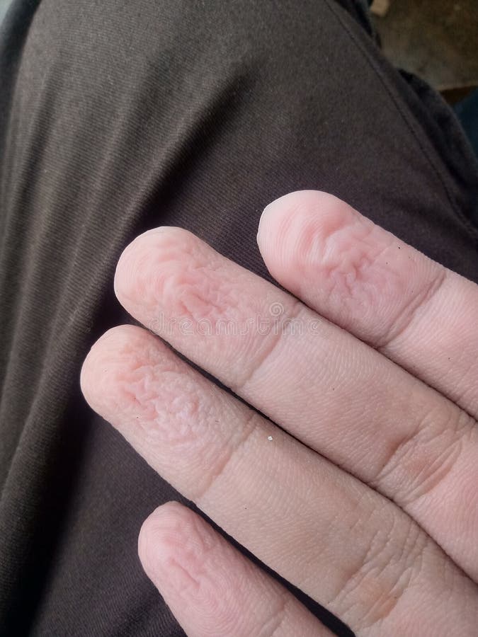 Wrinkled Skin on the Fingers Due To Exposure To Water Stock Photo ...