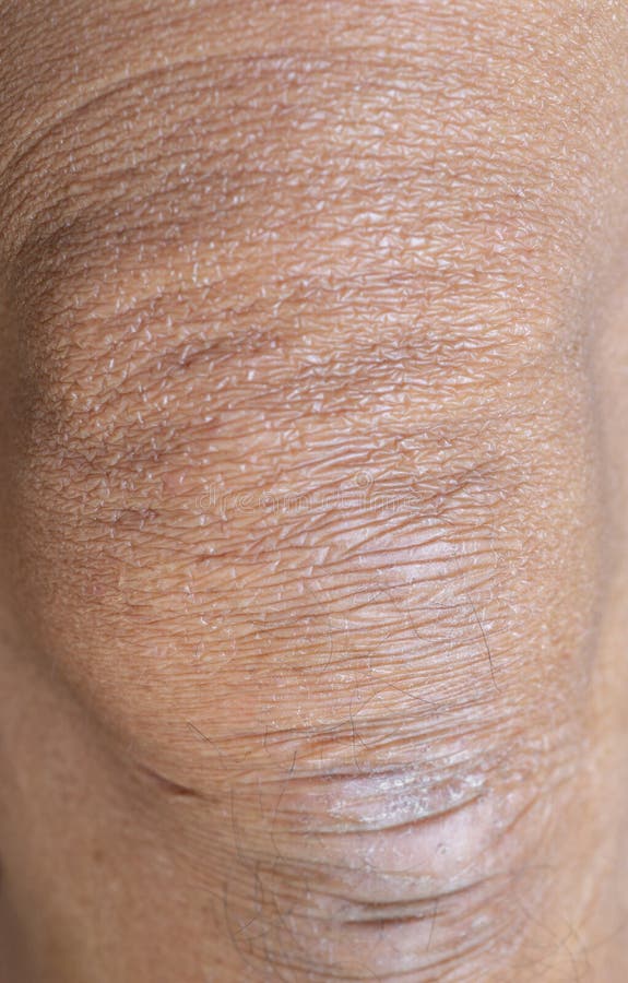 Wrinkles and Rough Skin on the Knee Stock Photo - Image of harsh ...