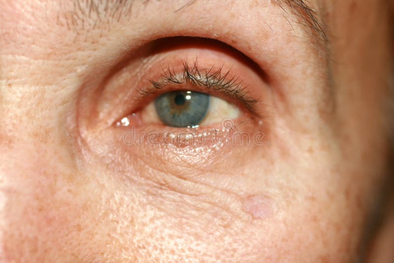 Wrinkles Under the Eyes. Wrinkles on the Skin of the Face Stock Photo ...