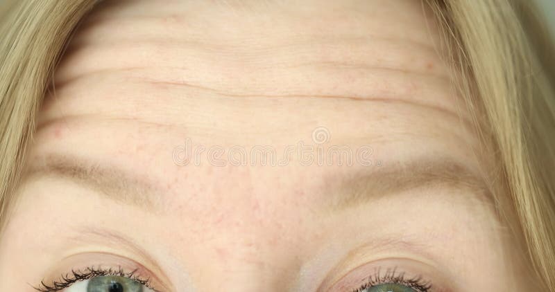 Wrinkles on a Woman S Forehead. Woman Surprised, Raised Eyebrows and ...