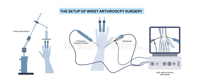 Wrist Arthroscopy Surgery Stock Vector Illustration Of Cartilage