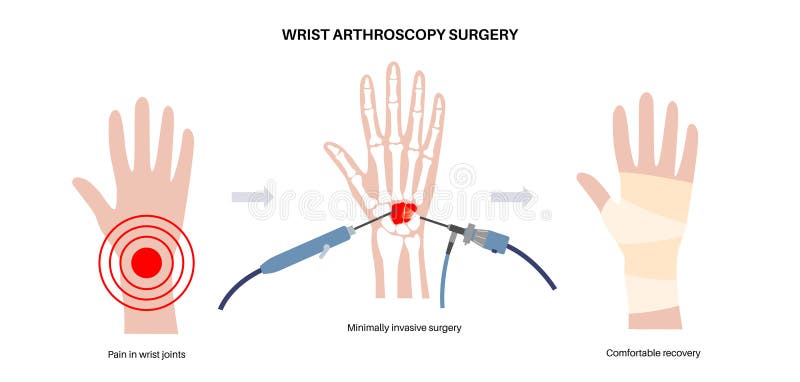 Wrist Arthroscopy Surgery Stock Illustration Illustration Of