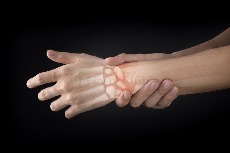 Wrist bones injury stock image. Image of phalanges, ache - 130533301