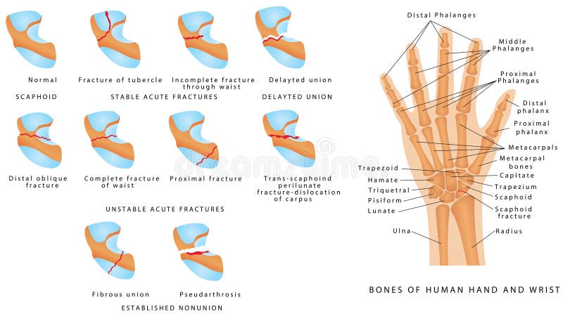 Wrist fracture Scaphoid stock vector. Illustration of phalanges - 191916003