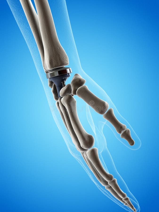 A wrist replacement stock illustration. Illustration of orthopaedic ...