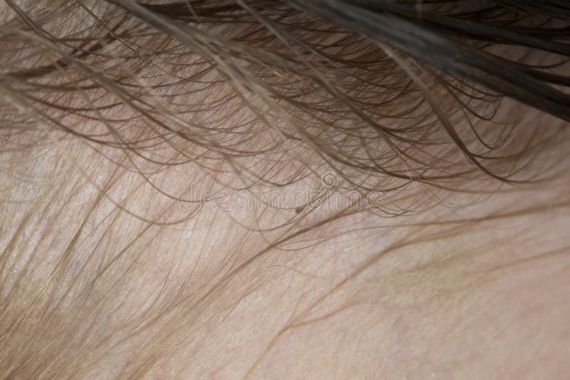 Wszy obraz stock. Obraz złożonej z szkoła, dandruf, dzieci - 23263411