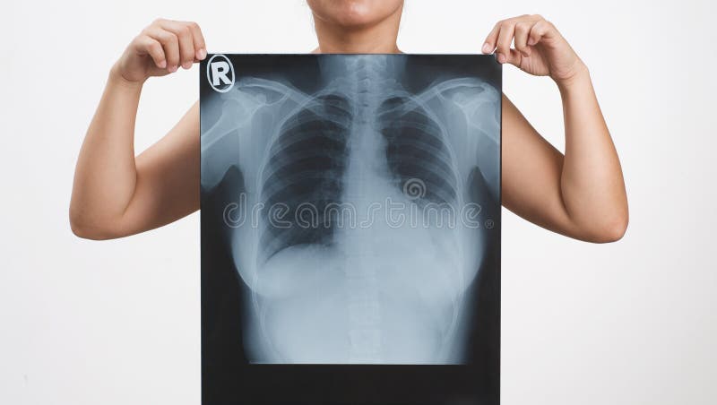 X-ray stock image. Image of chest, medical, heart, isolated - 14833315
