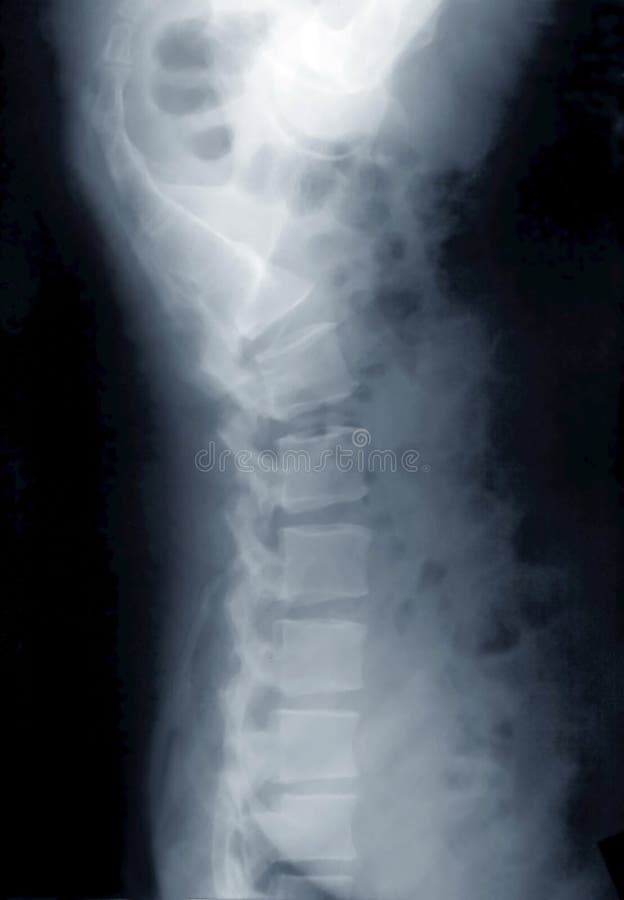 X-ray stock image. Image of medicine, gray, physical - 20156977