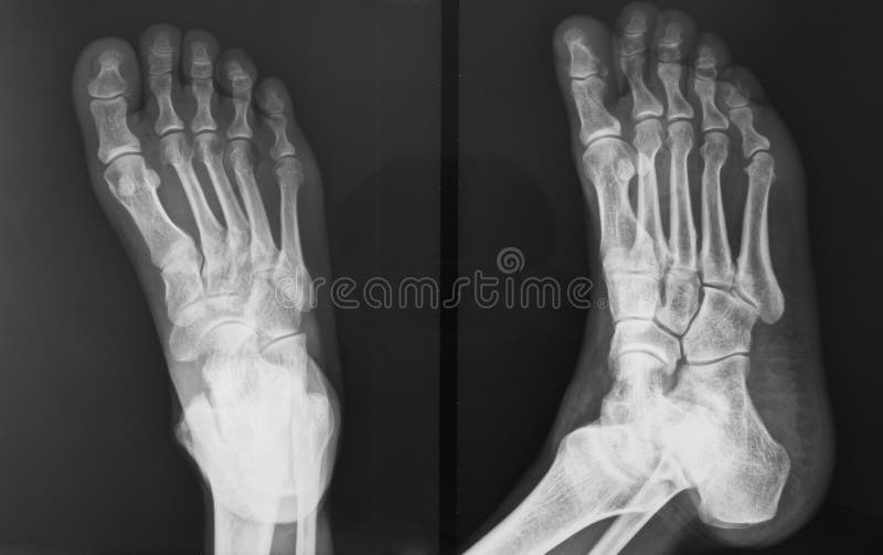 Right Foot Top Xray stock photo. Image of medical, bone - 23575678